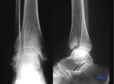 Anterolateral approach to the distal tibia