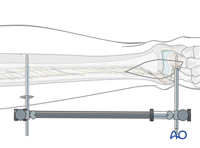 Anterolateral approach to the distal tibia