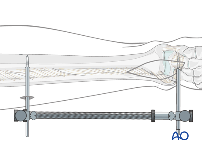 Anterolateral approach to the distal tibia