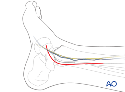 Posteromedial approach to the distal tibia