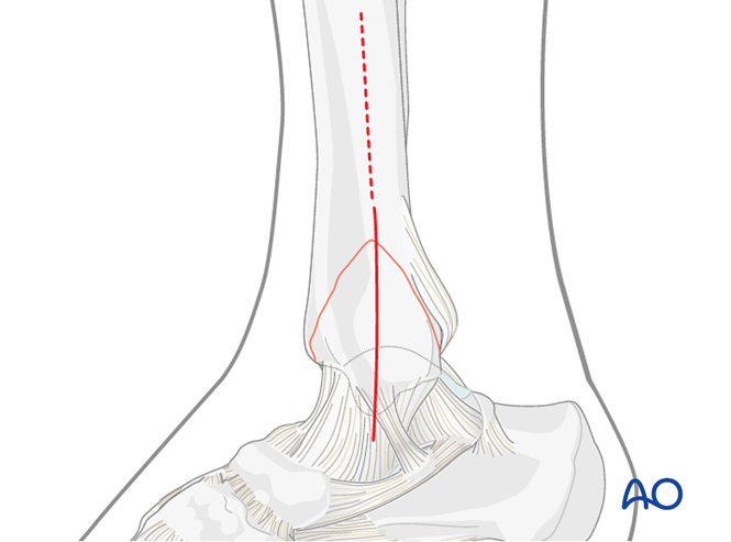 Medial approach to the distal tibia