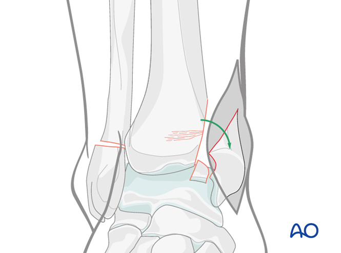 Medial approach to the distal tibia