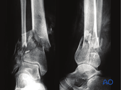 Minimally invasive approach to the distal tibia
