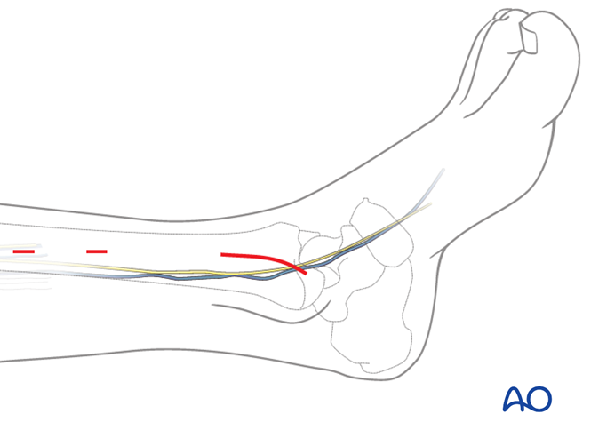 Minimally invasive approach to the distal tibia