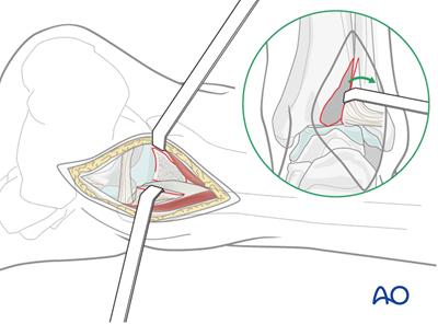 Posterolateral limited open approach to the distal tibia