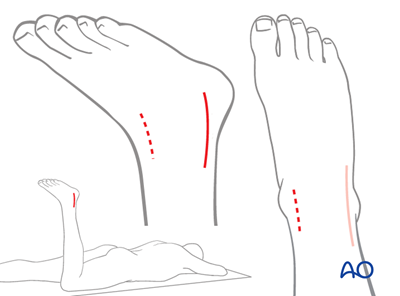 Posterolateral limited open approach to the distal tibia