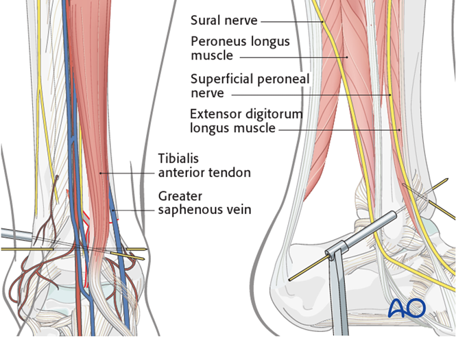 Safe zones in the tibia