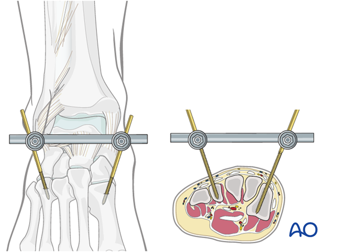 Safe zones in the tibia