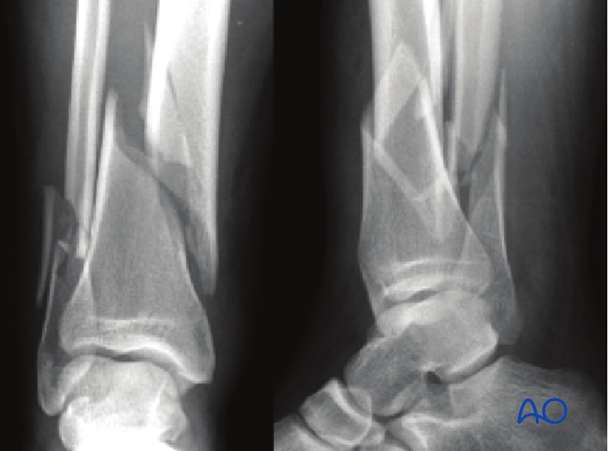 Extraarticular, wedge fracture