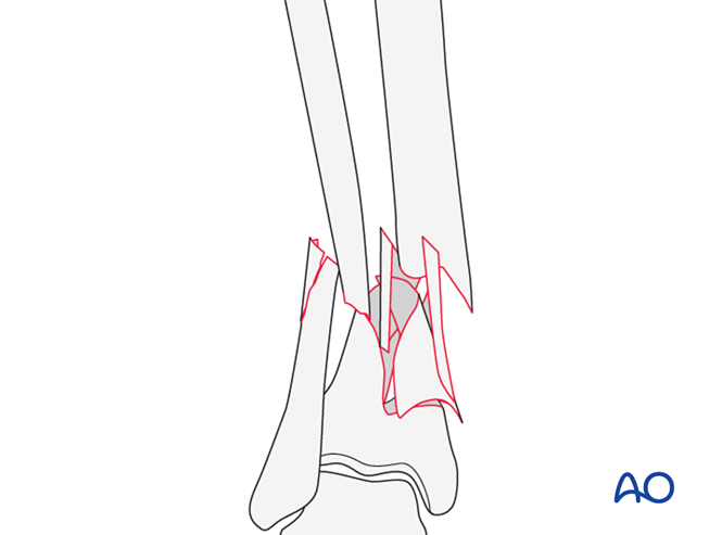 Extraarticular, multifragmentary fracture