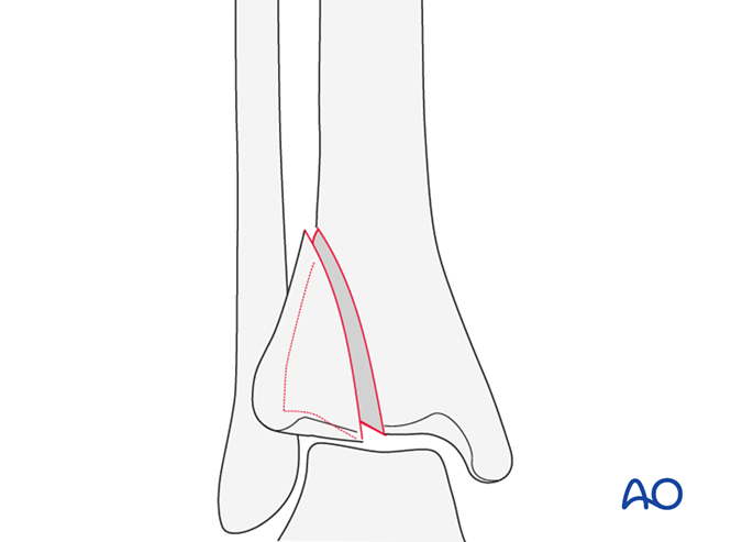Partial articular, split fracture