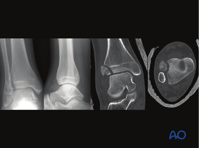 Partial articular, split fracture