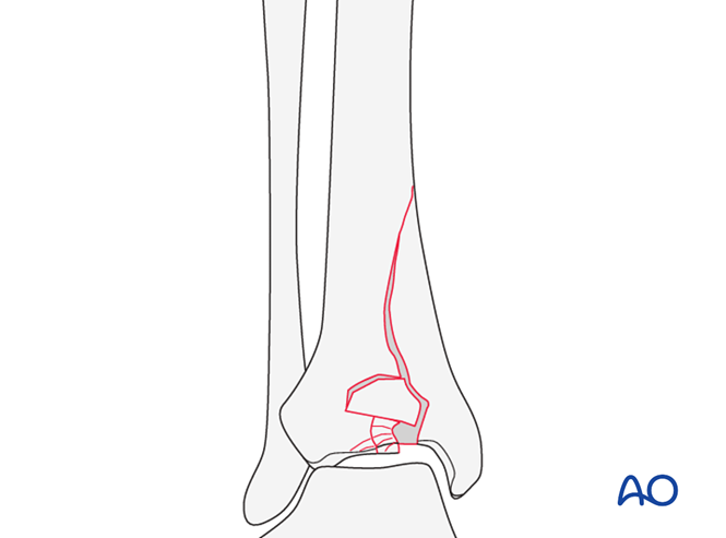 Partial articular, split depression fracture