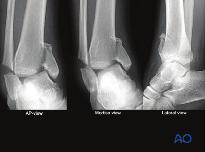 Partial articular, split depression fracture