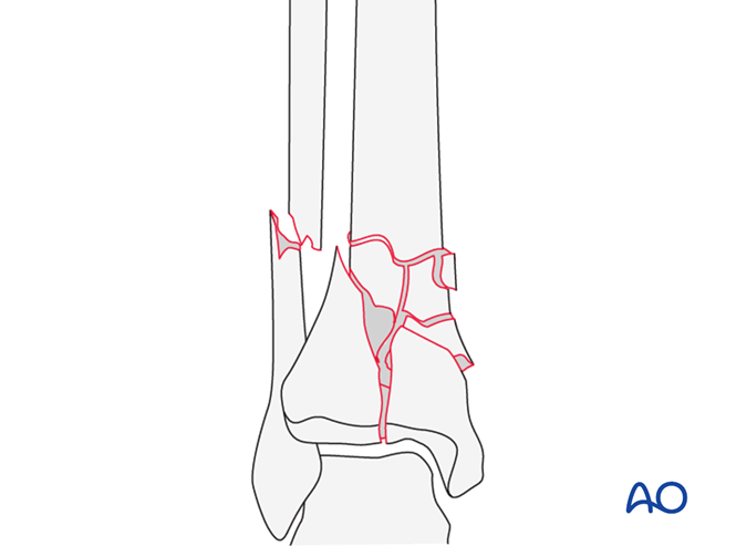 Complete simple articular, multifragmentary metaphyseal fracture