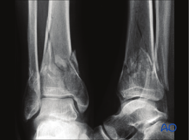 Complete simple articular, multifragmentary metaphyseal fracture