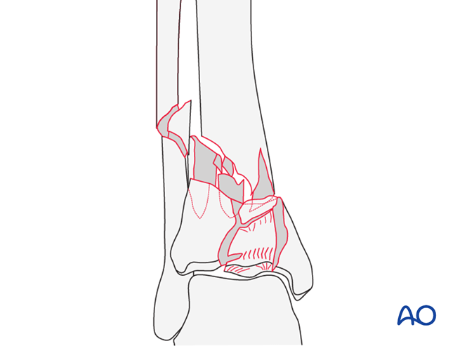 Complete, multifragmentary articular and metaphyseal fracture