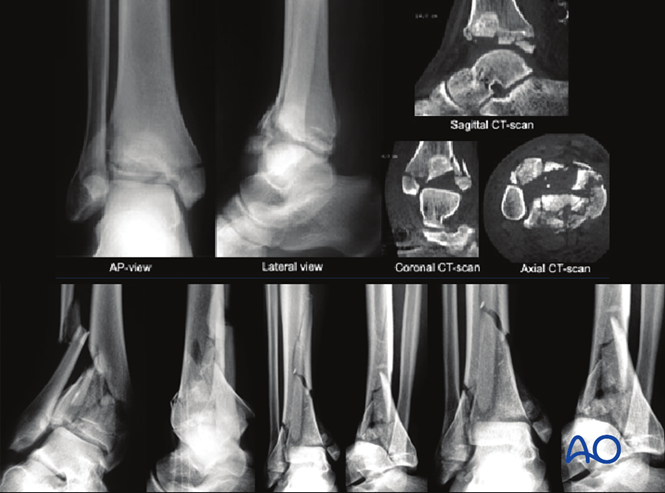 Complete, multifragmentary articular and metaphyseal fracture