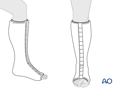 Nonoperative treatment - Definitive cast for Complete simple articular ...
