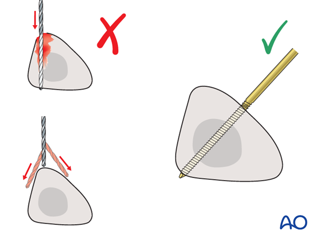Temporary joint-bridging triangular external fixation for Partial ...