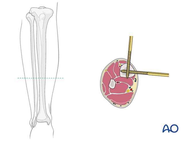 Full ring external fixation (Ilizarov) for Extraarticular, simple fracture
