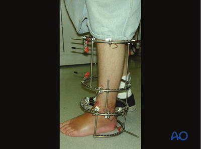 Full ring external fixation (Ilizarov) for Extraarticular, simple fracture