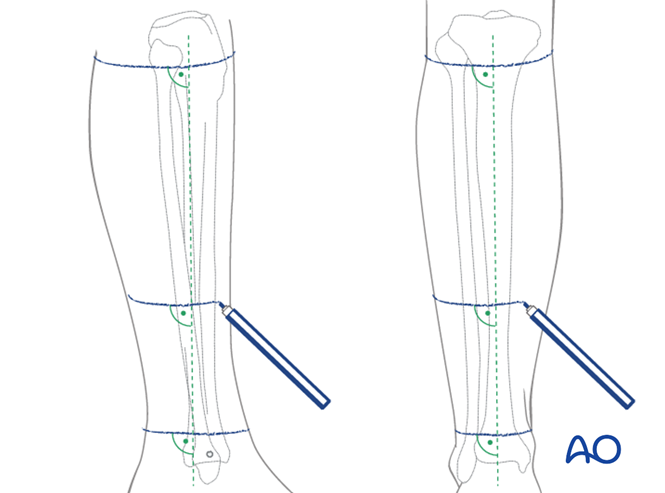 Full ring external fixation (Ilizarov) for Extraarticular, simple fracture