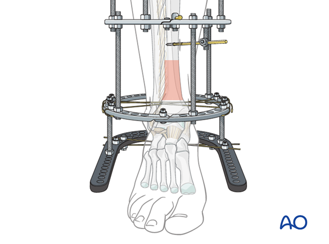 Full ring external fixation (Ilizarov) for Extraarticular, simple fracture