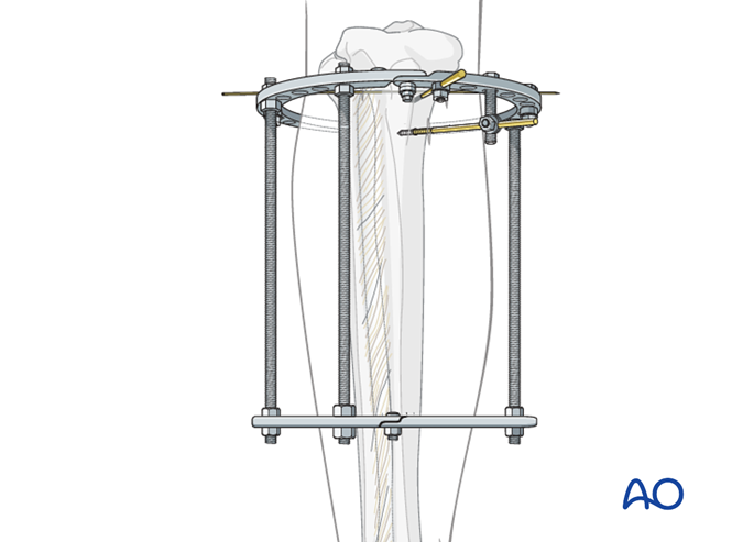 Full ring external fixation (Ilizarov) for Extraarticular, simple fracture