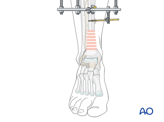Full ring external fixation (Ilizarov) for Extraarticular, simple fracture