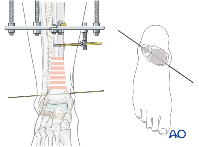 Full ring external fixation (Ilizarov) for Extraarticular, simple fracture