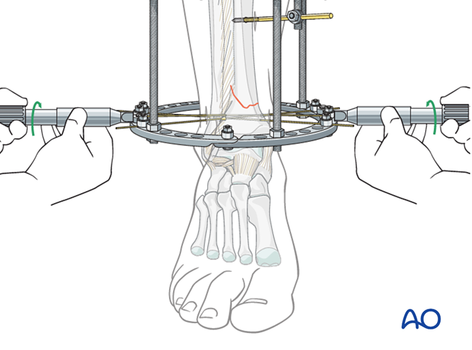 Full ring external fixation (Ilizarov) for Extraarticular, simple fracture