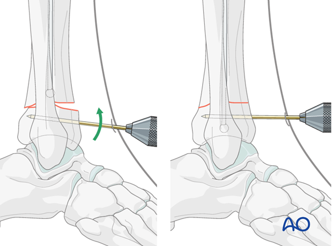 MIO - Intramedullary nail for Extraarticular, simple fracture
