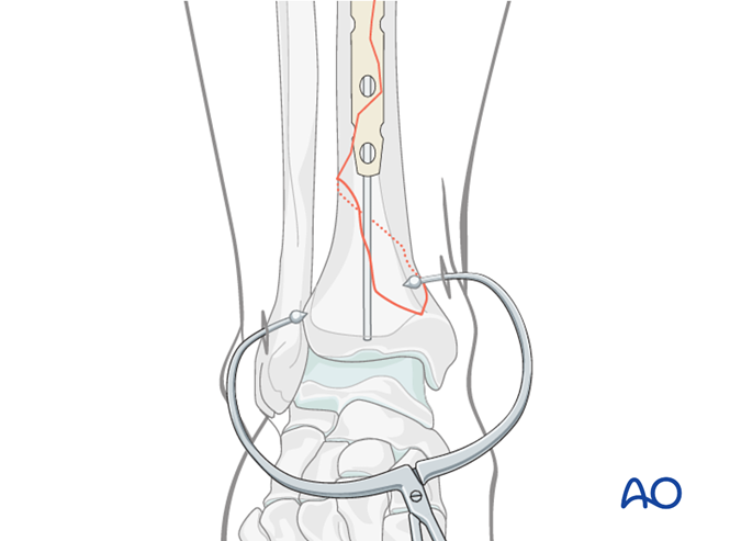 MIO - Intramedullary nail for Extraarticular, wedge fracture