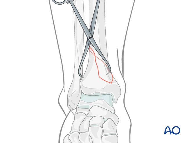 MIO - Intramedullary nail for Extraarticular, simple fracture