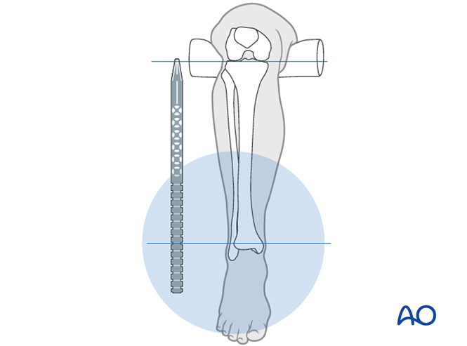 MIO - Intramedullary nail for Extraarticular, simple fracture