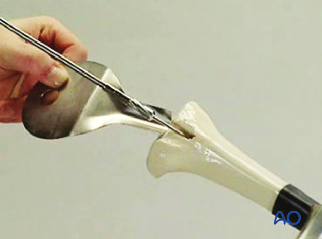 MIO - Intramedullary nail for Extraarticular, simple fracture