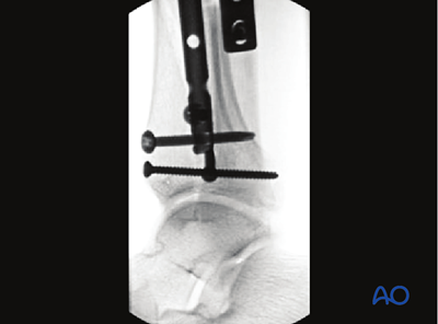 MIO - Intramedullary nail for Extraarticular, multifragmentary fracture