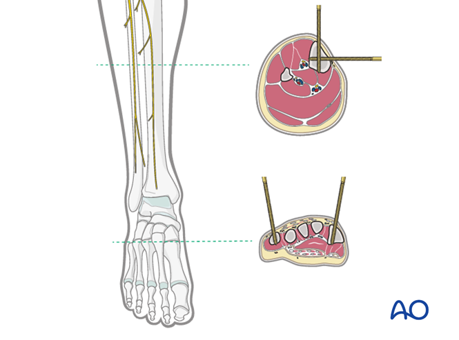Temporary joint-bridging triangular external fixation for Complete ...