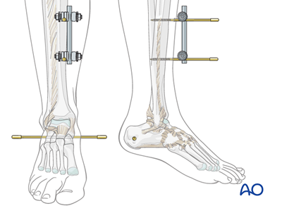 Temporary joint-bridging triangular external fixation for Complete ...