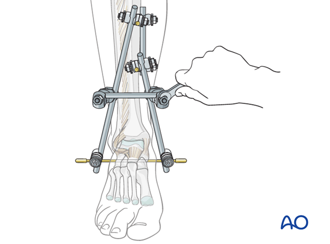 Temporary joint-bridging triangular external fixation for Complete ...