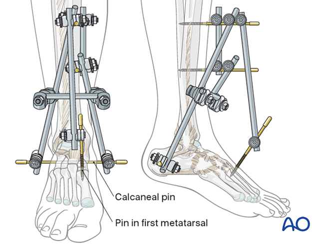 Temporary joint-bridging triangular external fixation for Partial ...