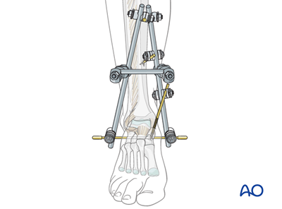 Temporary joint-bridging triangular external fixation for Partial ...