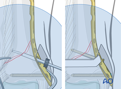 MIO - Compression plate for Extraarticular, simple fracture