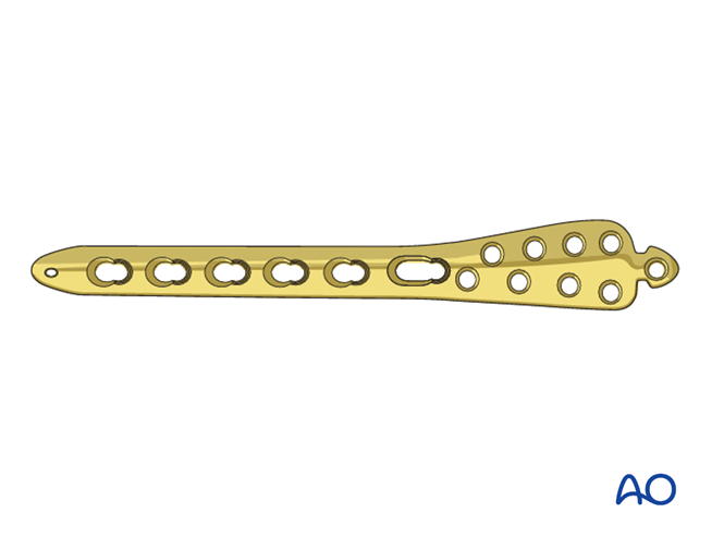 MIO - Compression plate for Extraarticular, simple fracture