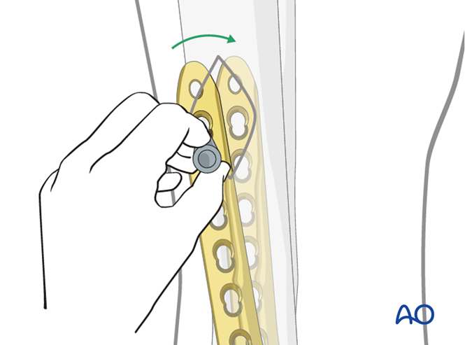 ORIF - Plate and screws for Complete simple articular, simple ...