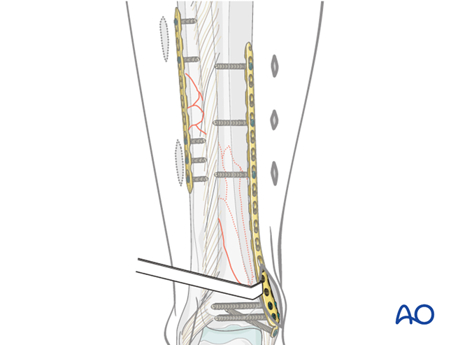 MIO - Bridge plate for Extraarticular, multifragmentary fracture
