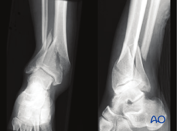 Distal Tibia Fracture