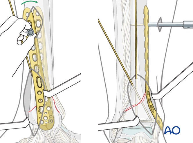 ORIF - Compression plate for Extraarticular, simple fracture