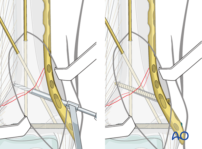 ORIF - Compression plate for Extraarticular, simple fracture